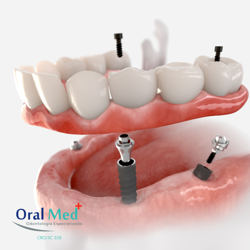 Prótese Protocolo - OralMed Odontologia Especializada