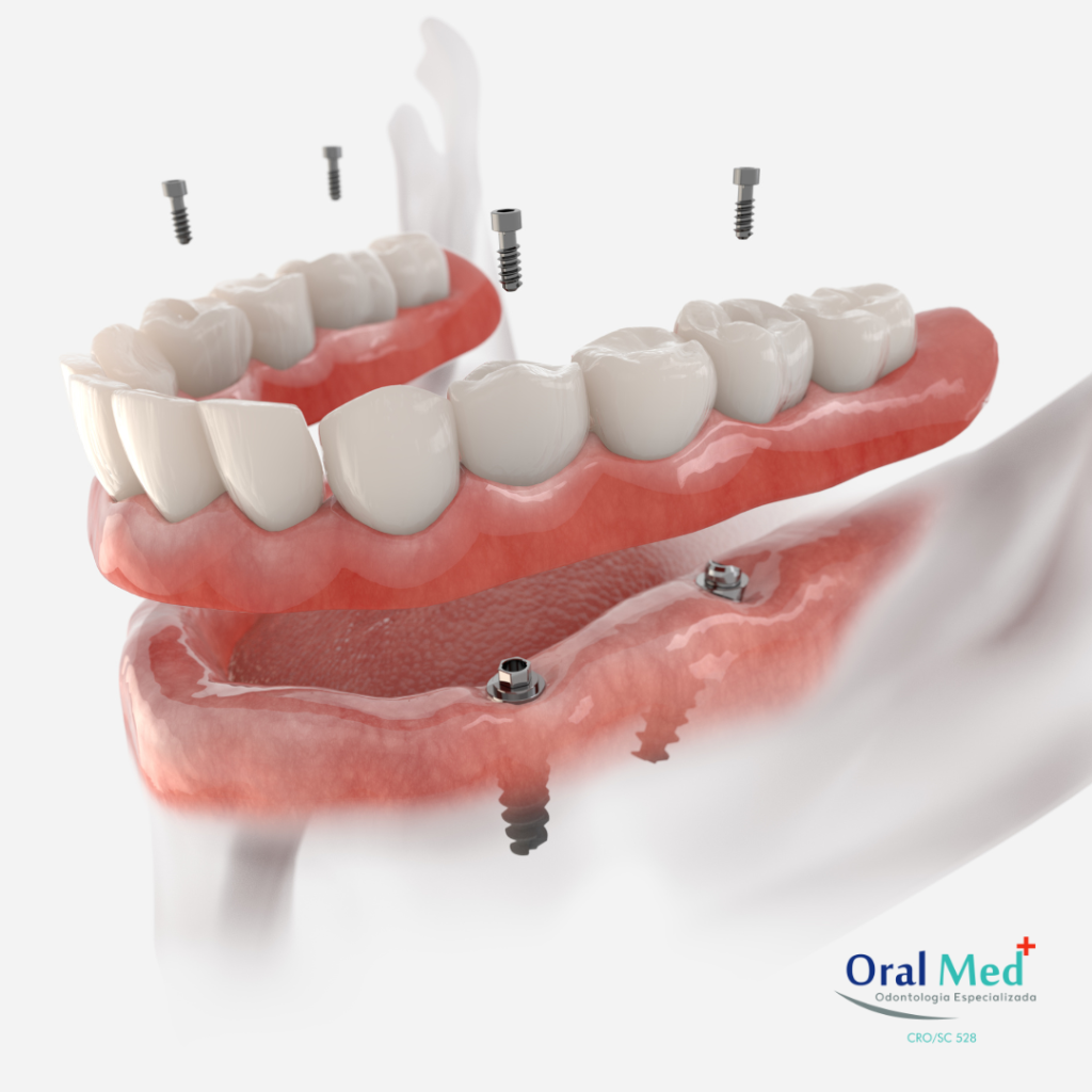 Como é colocada a prótese tipo protocolo - OralMed Odontologia ...