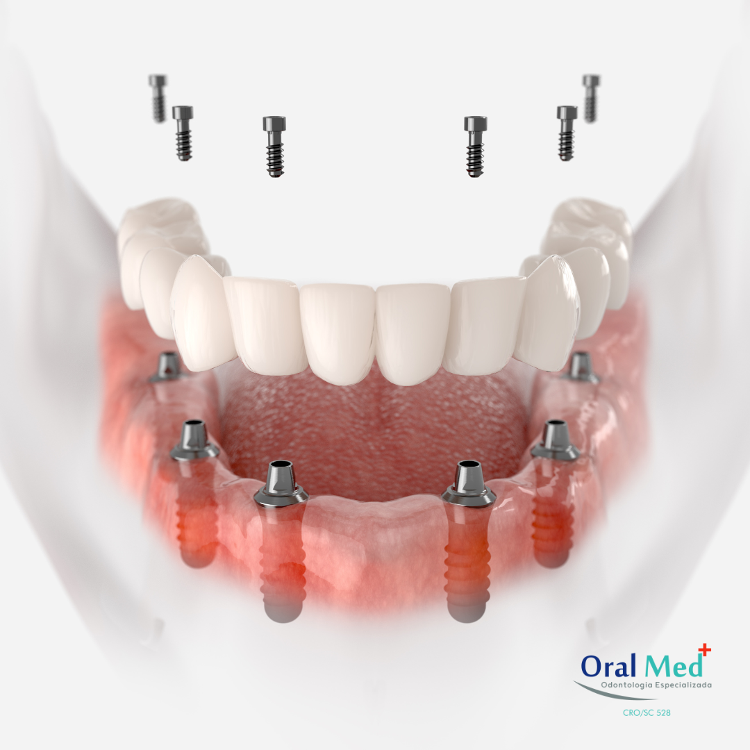 A manutenção das próteses tipo protocolo - OralMed Odontologia ...